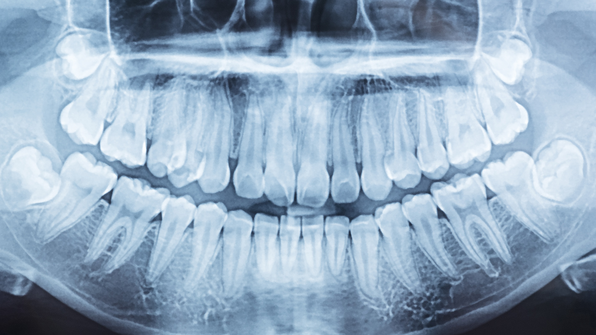 What Are Premolars? Learn About Them Here | Rock Family Dental